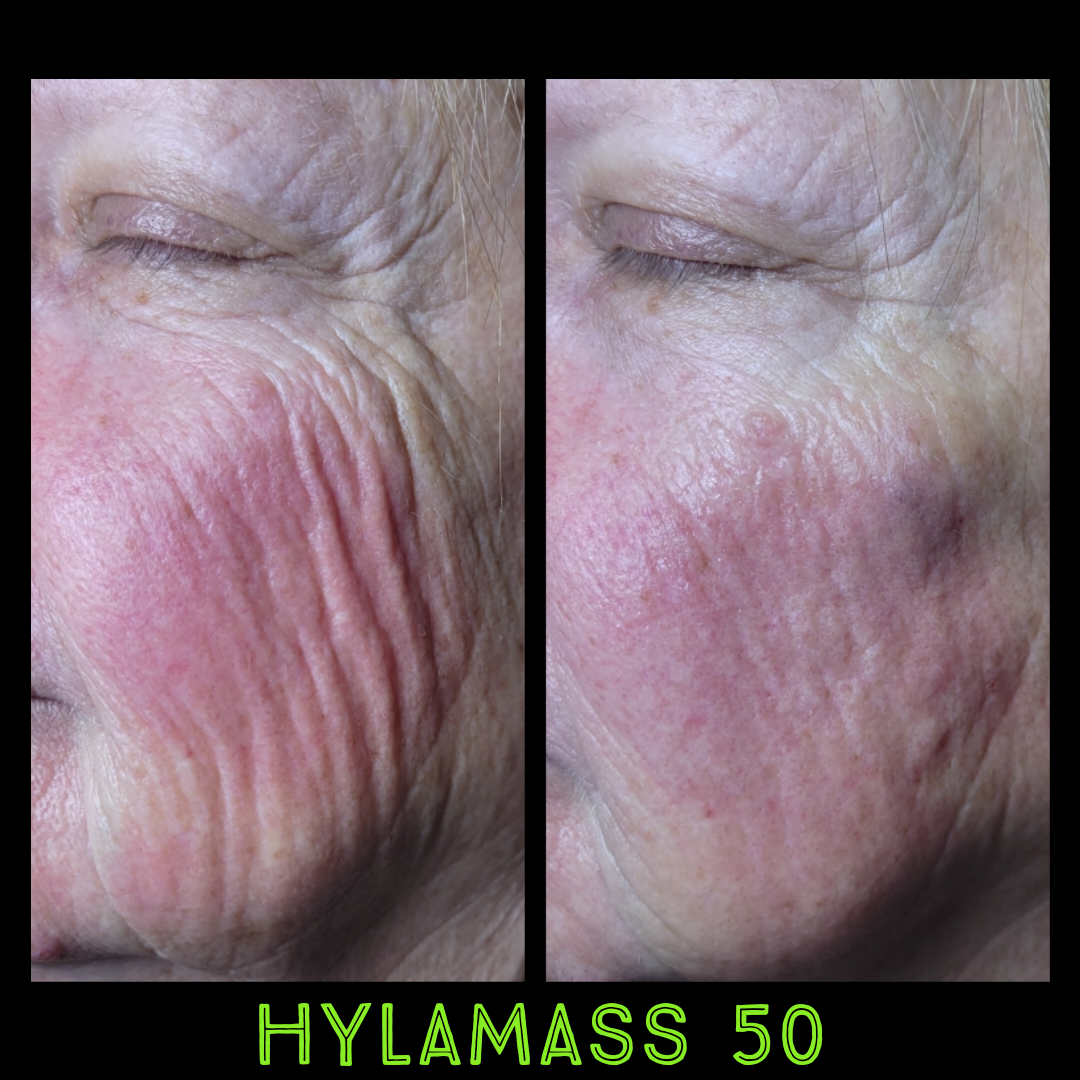 Hyalmass 50 High Concentrated HA Skin Booster: Your Ultimate Guide to ...